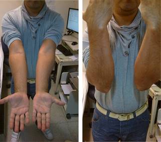 Acute distal biceps repair using double incision technique: results of ...