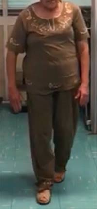 Conservación de injerto autólogo de cabeza femoral en colgajo óseo para ...