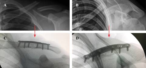 Osteosíntesis mínimamente invasiva con placa anatómica bloqueada en ...