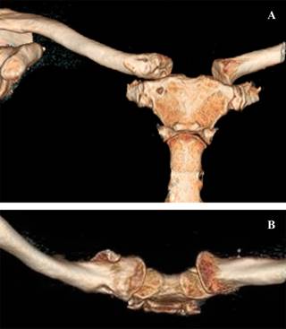 Luxación esternoclavicular anterior, descripción de técnica quirúrgica
