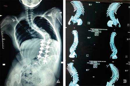 Tratamiento de deformidad severa de la columna vertebral con modelos de ...