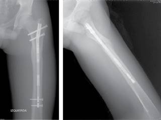 Primera serie de casos de alargamiento femoral mediante clavo ...