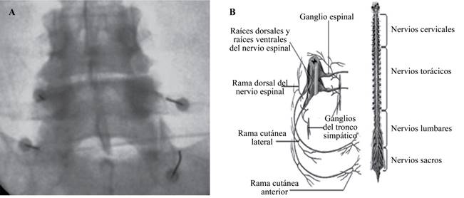 Neuromodulación percutánea utilizando radiofrecuencia pulsada versus ...