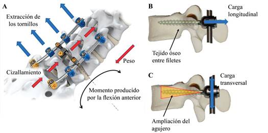 Biomecánica de la interfaz hueso-tornillo en instrumentación ...