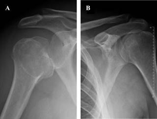 Luxofractura posterior bilateral de hombro secundaria a episodio de ...