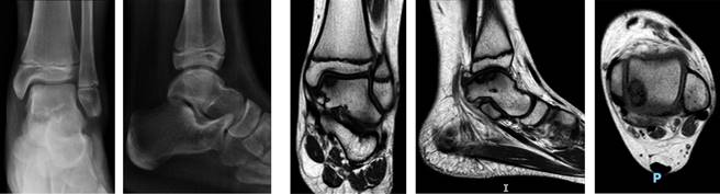 Evaluation and management of osteochondral lesions of the talus in ...