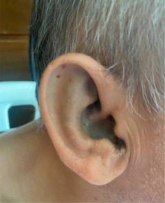 Alcaptonuria: evolución y curso de la enfermedad hacia artropatía ...