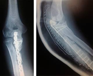 Dehiscencia de herida quirúrgica y exposición material de osteosíntesis ...