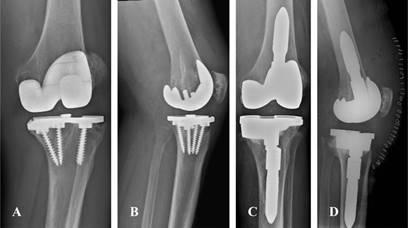 Resultados preliminares de la artroplastía de revisión de rodilla con ...