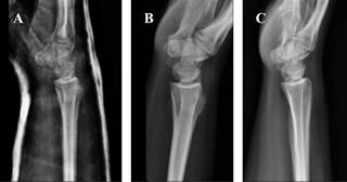 Extensor Pollicis Longus Rupture