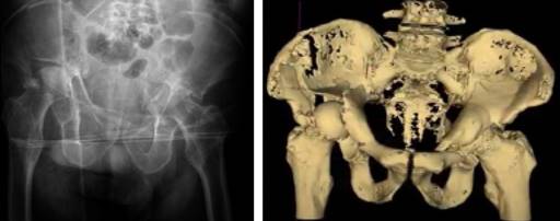 Luxación bilateral central femoral tras crisis convulsiva. Anillo ...