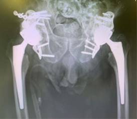 Luxación bilateral central femoral tras crisis convulsiva. Anillo ...