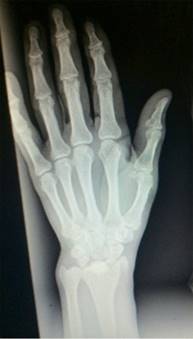 Anterior dislocation of the lunate due to a high-energy trauma
