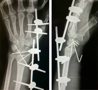 Anterior dislocation of the lunate due to a high-energy trauma