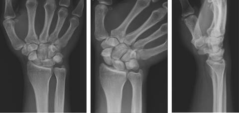 Late consolidation of the scaphoid. Case report and literature review