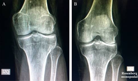 Prótesis unicompartimental de rodilla