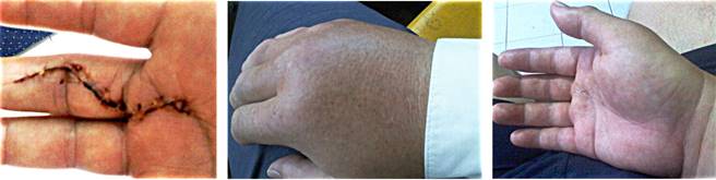 Clinical course of a complex regional pain syndrome type II in upper limb