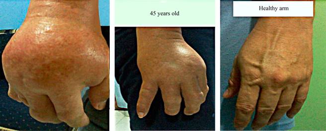Clinical course of a complex regional pain syndrome type II in upper limb