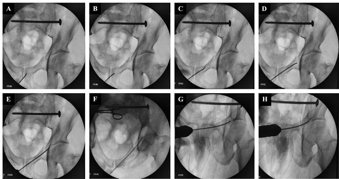 Superior pubic ramus fixation with titanium elastic nails-surgical ...