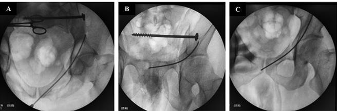 Superior pubic ramus fixation with titanium elastic nails-surgical ...