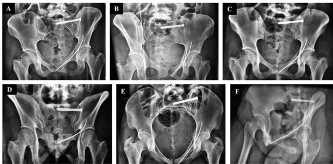 Superior pubic ramus fixation with titanium elastic nails-surgical ...