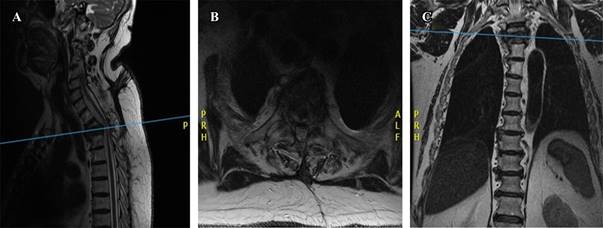 Infraclavicular anterior thoracic approach for access to the upper ...