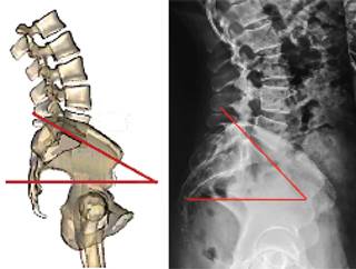 Evaluación de la movilidad espino-pélvica; su importancia para prevenir ...