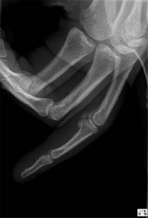 Acute calcific periarthritis in a proximal interphalangeal joint of the ...