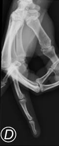 Acute calcific periarthritis in a proximal interphalangeal joint of the ...