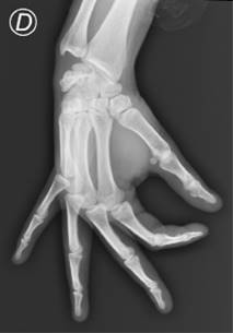 Acute calcific periarthritis in a proximal interphalangeal joint of the ...