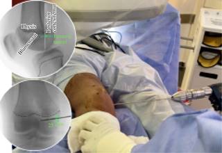 Allograft reconstruction of the medial patellofemoral complex in ...