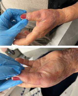Volar dislocation of the metacarpophalangeal joint of the thumb: open ...