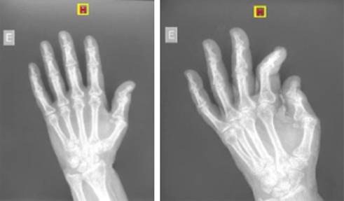 Volar dislocation of the metacarpophalangeal joint of the thumb: open ...