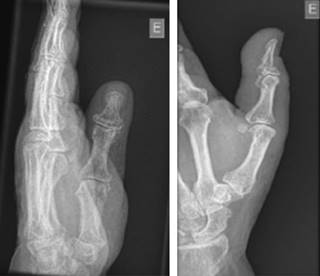 Volar dislocation of the metacarpophalangeal joint of the thumb: open ...