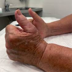 Volar dislocation of the metacarpophalangeal joint of the thumb: open ...