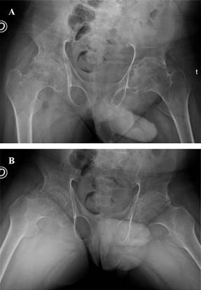 Artroplastía total de cadera bilateral en paciente de 15 años con ...