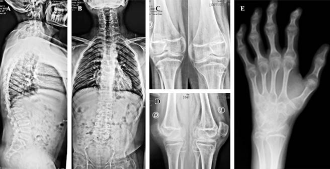 Artroplastía total de cadera bilateral en paciente de 15 años con ...