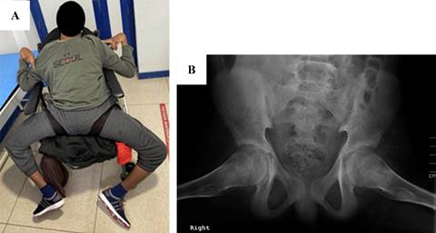 Severe rigid hip flexion-abduction contracture in cerebral palsy: a ...