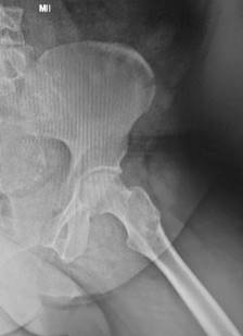 Necrosis avascular de la cabeza femoral tras COVID-19: presentación ...
