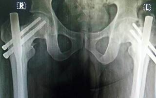 Comparative outcomes of PFN vs PFNA2 nailing for osteoporotic unstable ...