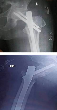 Comparative outcomes of PFN vs PFNA2 nailing for osteoporotic unstable ...