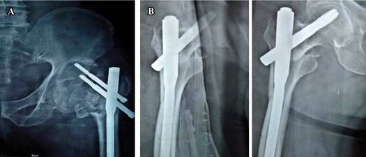 Comparative outcomes of PFN vs PFNA2 nailing for osteoporotic unstable ...