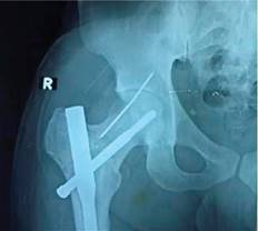 Comparative outcomes of PFN vs PFNA2 nailing for osteoporotic unstable ...