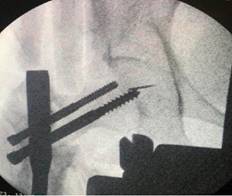 Comparative outcomes of PFN vs PFNA2 nailing for osteoporotic unstable ...