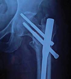 Comparative outcomes of PFN vs PFNA2 nailing for osteoporotic unstable ...