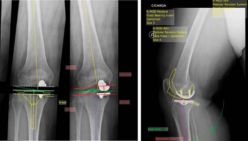 Conversiones de prótesis unicompartimentales fallidas a reemplazo total ...