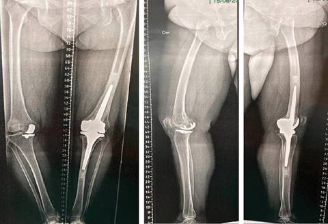 Conversiones de prótesis unicompartimentales fallidas a reemplazo total ...
