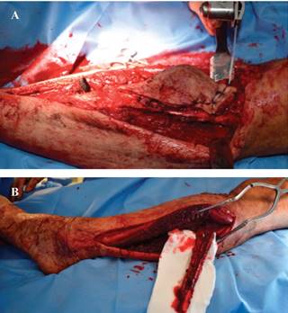 Silent surface osteosarcoma treated following the hemi-capanna ...