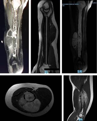 Upper limb salvage with massive intercalary allograft for humeral ...