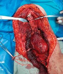 Upper limb salvage with massive intercalary allograft for humeral ...